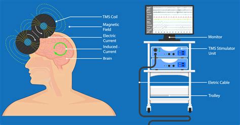 Implementing TMS As A Potential Solution For Treatment Neuromind TMS Psychiatrist