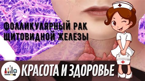 Фолликулярный рак щитовидной железы симптомы лечение прогноз после операции