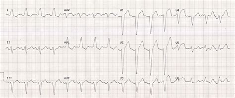 How To Diagnose Left Bundle Branch Block With Ecg New Health Advisor