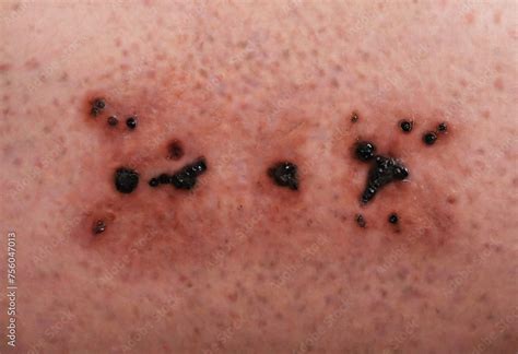 Pox Smallpox Mpox Pathogen Bacteria Biotechnology Bacterium Biolaboratory New X Disease