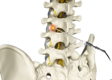 Radio Frequency Treatments Ashirvad Institute For Pain Management And Research AIPMR