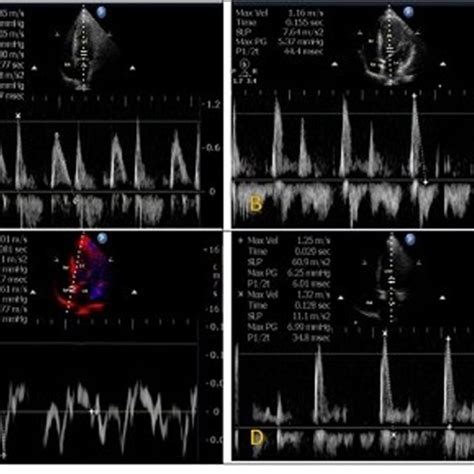 Grading Of Diastolic Dysfunction At Baseline Download Table