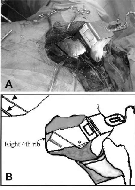 A Intraoperative Photograph Shows The Partial Sternotomy And Small Download Scientific Diagram