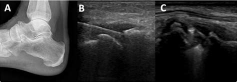 Talonavicular Joint Injection Wikism Sports Medicine Wiki