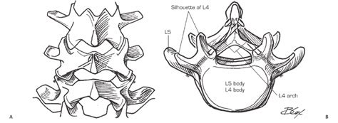 Facet Screw Placement Neupsy Key