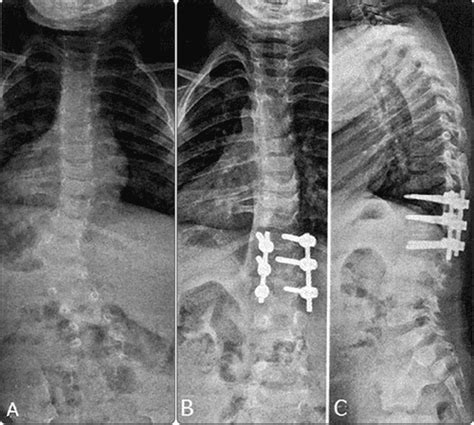 Table 1 From Single Stage Posterior Hemivertebra Resection With