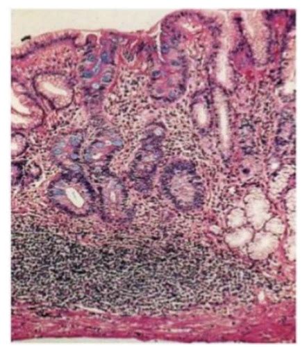 006b Cmed 222 Pathology Of The Stomach And Duodenum Flashcards Quizlet