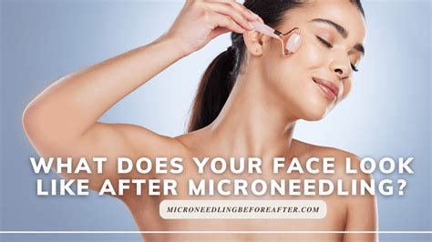 What Does Your Face Look Like After Microneedling