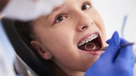 Conventional Vs Self Locking Braces What To Choose