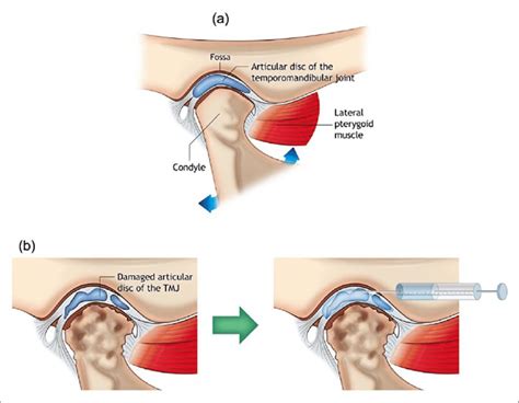 A Schematic Image Of The Anatomical Structure Of Temporomandibular