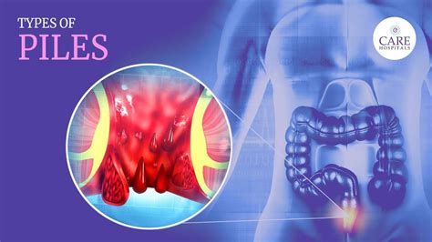 What Are Hemorrhoidspiles What Are The Types Of Piles How To Diagnose Piles बवासीर Youtube