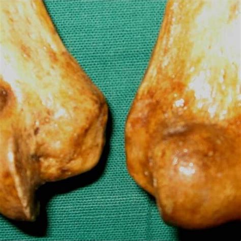 X Ray Of Humerus Showing A Supratrochlear Foramen B 2 Minute Opening Download Scientific