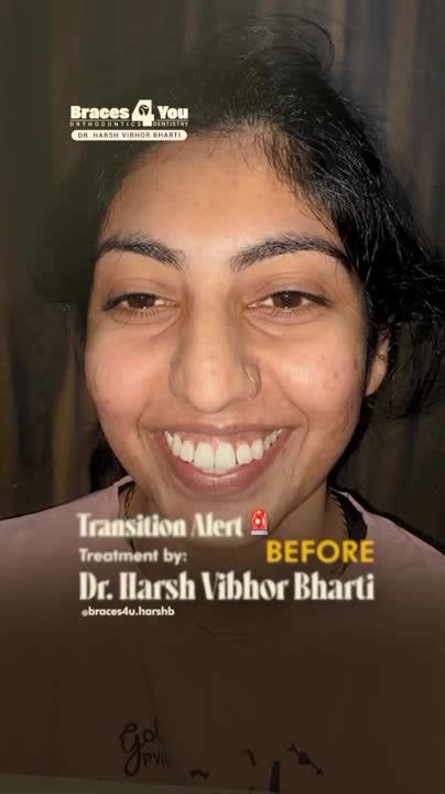harsh bharti on linkedin bracesnomore smilemakeover