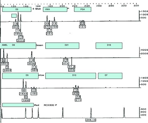 Sperm Fraction Electropherogram From Victims Vaginal Swab After