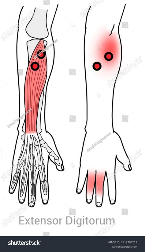 Myofascial Trigger Point Extensor Digitorum Stock Illustration 2412798213 Shutterstock