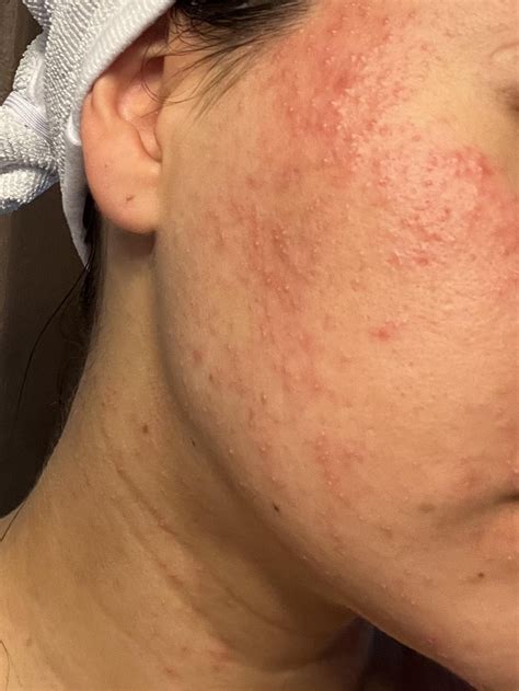 Helpppp Meeee Rfungalacne