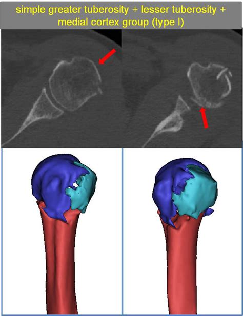 Morphological Analysis Of Fractures Of The Proximal Humerus By The