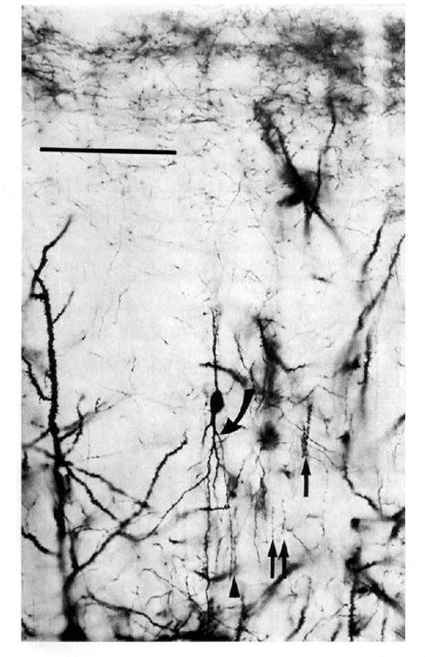 Cortical Congenital Hyperostosis Semantic Scholar