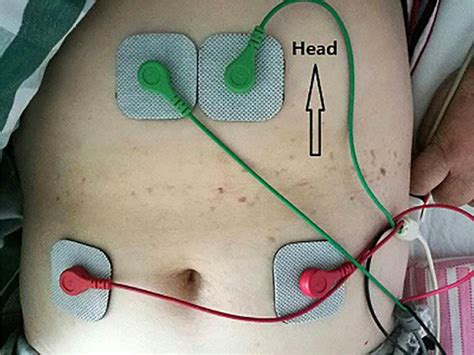 The Efficacy And Safety Of Transcutaneous Acupoint Interferential