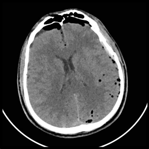 Stroke Object Detection Model By Stroke