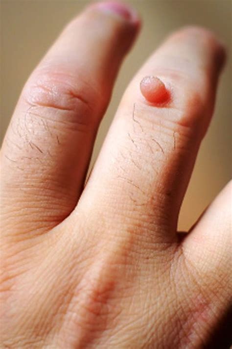 You Might Be Able To Make Your Warts Disappear With Duct Tape Artofit