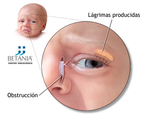 Obstruccion Del Conducto Lagrimal Sleep Eye Mask Duct Eyes