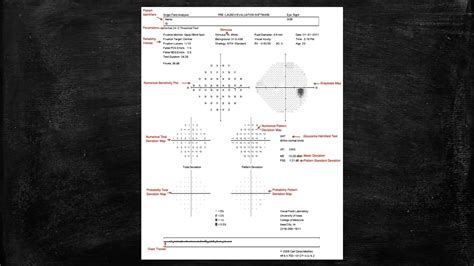 The Complete Approach To Glaucoma Evaluation Pptx