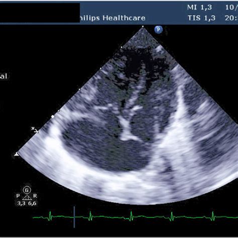 Transthoracic Echocardiography In The Suprasternal Notch View Showing Download Scientific