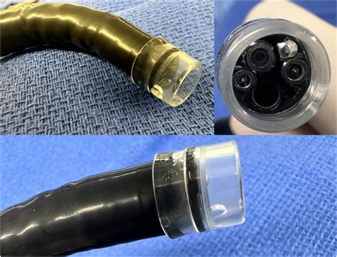 Flexible Zenkers Per Oral Endoscopic Myotomy Operative Techniques In