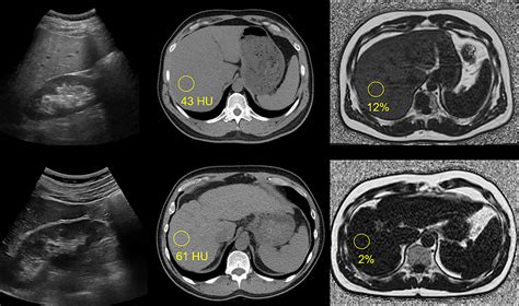 Noninvasive Quantitative Ct For Diffuse Liver Diseases Steatosis Iron Overload And Fibrosis