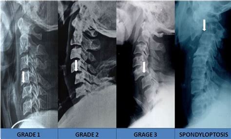 [figure Meyerding Grades Of Spinal Subluxation ] Statpearls Ncbi Bookshelf
