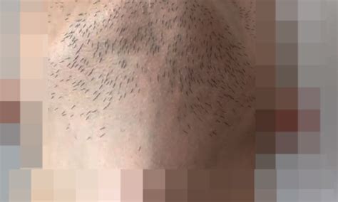 대구젠틀맥스프로플러스 남자레이저제모 4회 후기 아포지엘리트플러스 비교 네이버 블로그