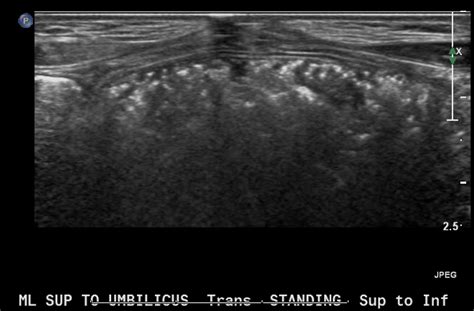 Divarication Of Recti Ultrasound Diastasis Rectus Abdominus Explaining How We Can Help Mums