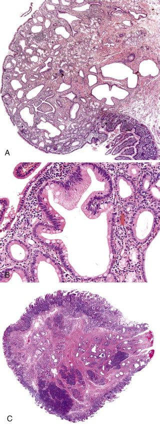 Tumors Of Major And Minor Ampulla Abdominal Key