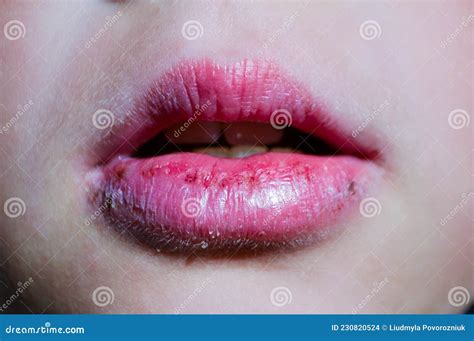 Angular Cheilitis Common Inflammation Of The Lips Royalty Free Stock