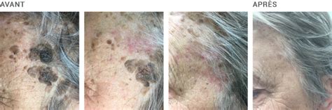 Témoignages Clients Satisfait Thermocoagulation