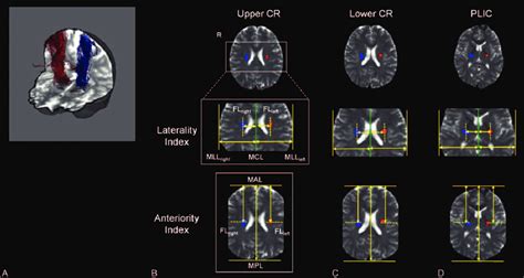 Measurement Procedures Of Laterality Index And Anteriority Index At