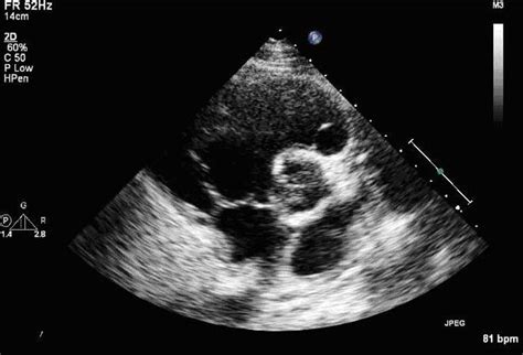 A Systematic Approach To Echocardiography In Hypertrophic