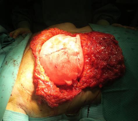 Adm Assisted Pre Pectoral Breast Reconstruction With Vertical Scar Download Scientific Diagram