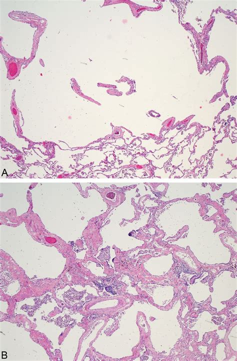 Smoking Related Pulmonary Fibrosis Radiology At Bruce Lohr Blog
