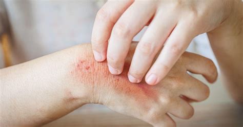 How To Cure Fungal Infection On Skin Naturally At Home