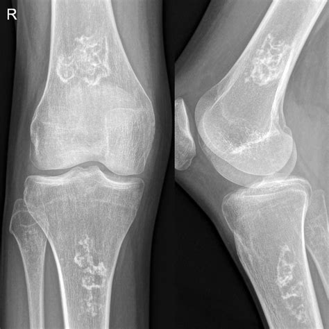 Acute Bone Infarct Due To Sickle Cell Anemia Pacs