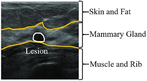 Schematic Of The Anatomical Structure Of A Breast Ultrasound Bus Download Scientific Diagram
