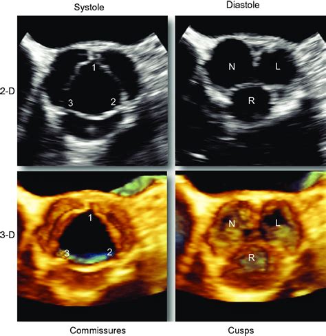 Normal Aortic Valve Echo Cardiac Ultrasound Echocardiography Made