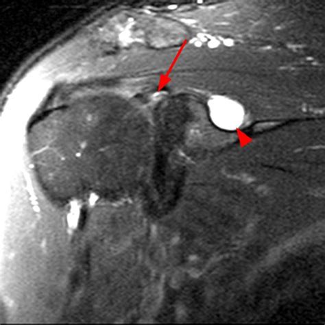 Subchondral Cyst Shoulder