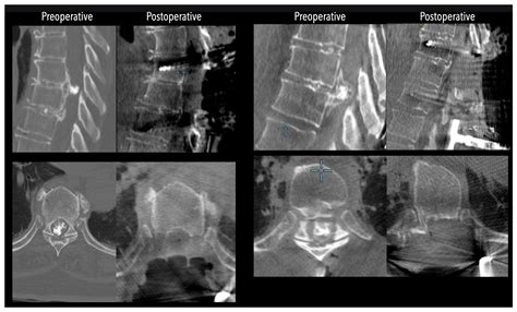 Transpedicular Transdural Approach For Calcified Thoracic Disc