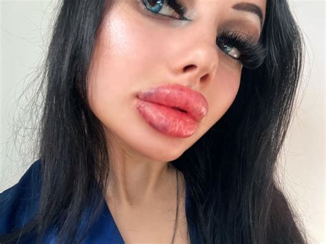 Big Bimbo Lips 💉👄💋 Rbimbolovers