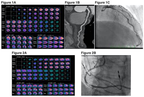 Exercise Stress Myocardial Perfusion Imaging — Sozocardiology Dr Ooi Yau Wei Interventional