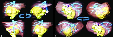 A Anteroposterior Rotatory Views Of The Spatial Anatomy Of The Tumour Download Scientific