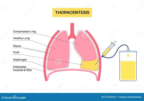 Thoracentesis Medical Procedure Vector Illustration
